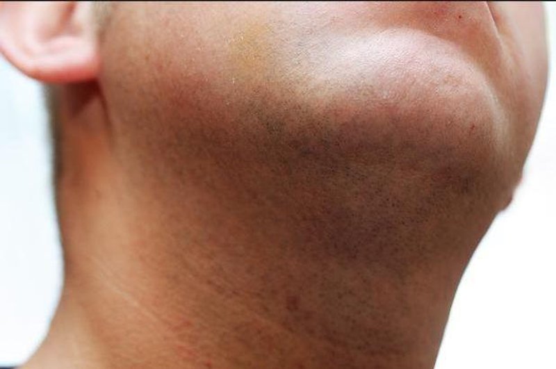 Darren Wilson Broken Eye Socket