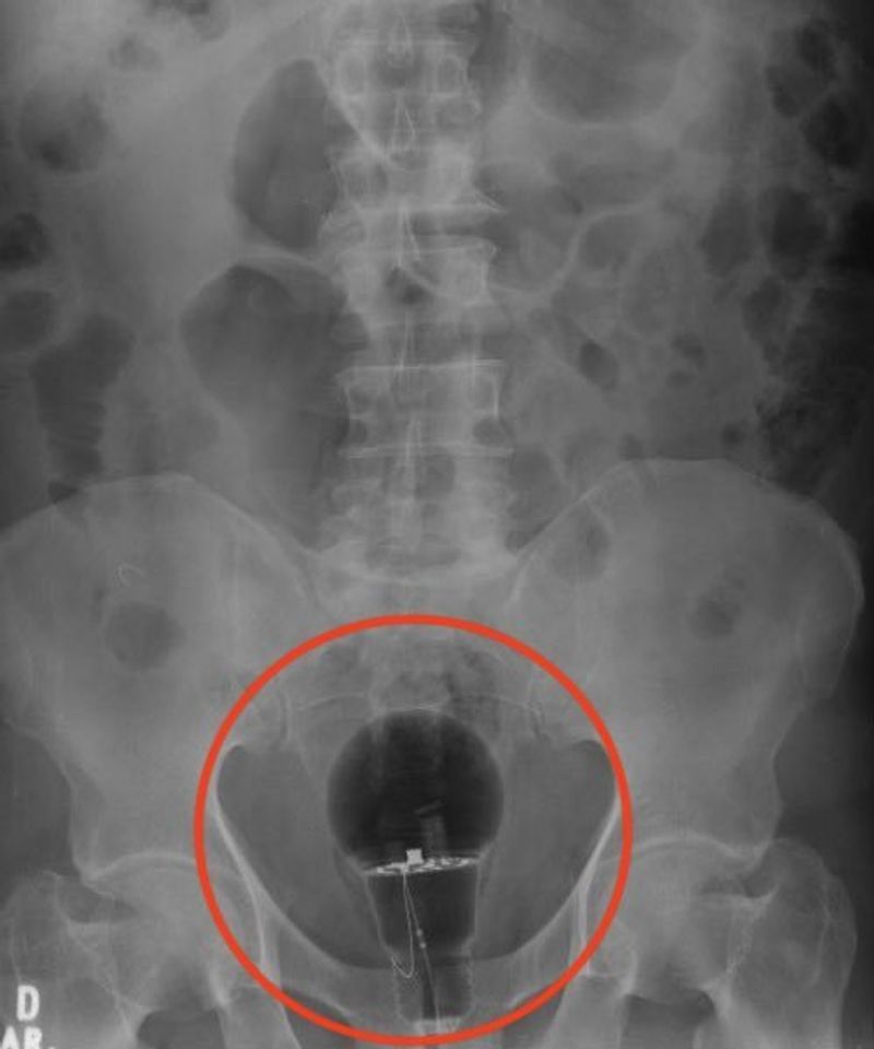 X Rays Of Objects Inside People The Beautiful Innards Of 19 Everyday