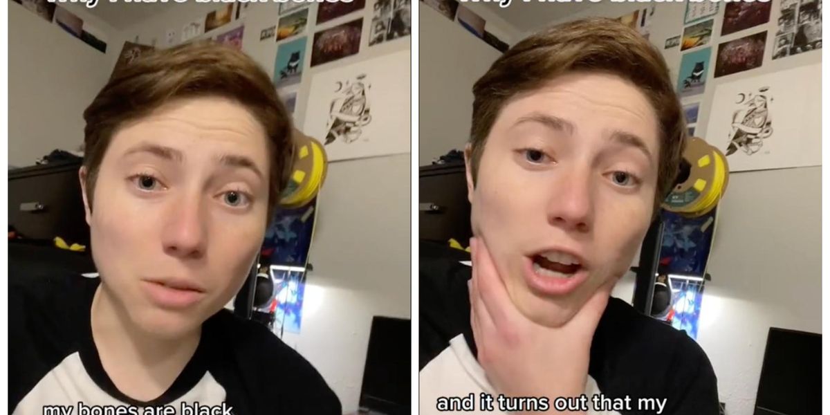Man discovers that his bones have turned 'black' after a trip to the ... Man discovers that his bones have turned 'black' after a trip to the ...