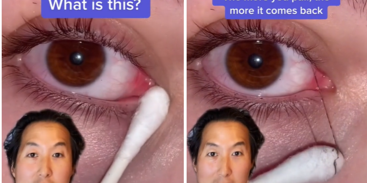 Experts Warn Against fishing Out Eye Mucus Trend As Seen On TikTok Experts Warn Against fishing Out Eye Mucus Trend As Seen On TikTok